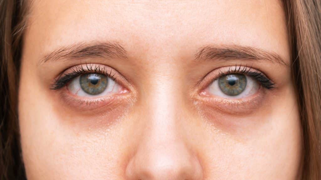 Podočnjaci kod djece: Kako nastaju i 10 načina kako ih tretirati